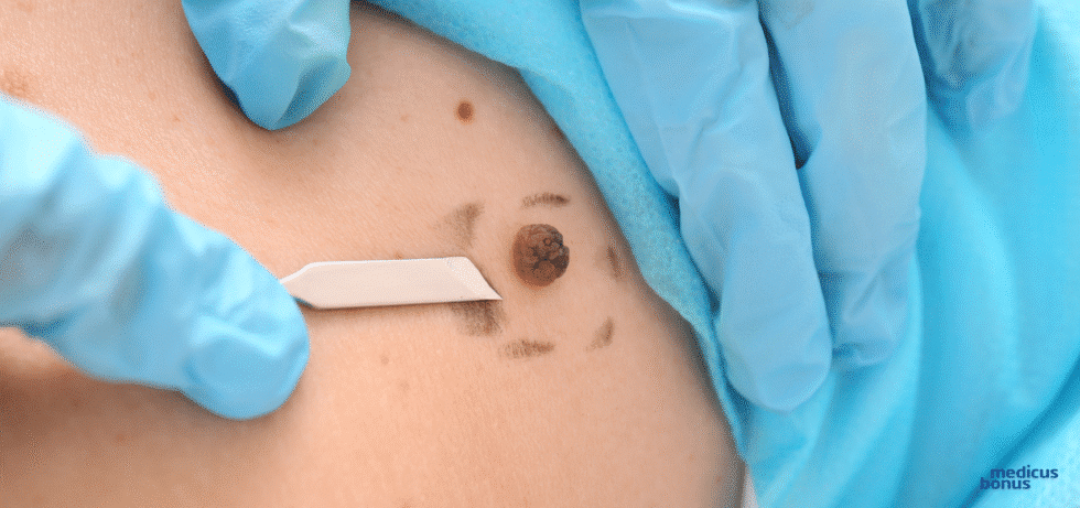 Pieprzyki - mały wielki problem ⋆ Poradnie Medicus Bonus